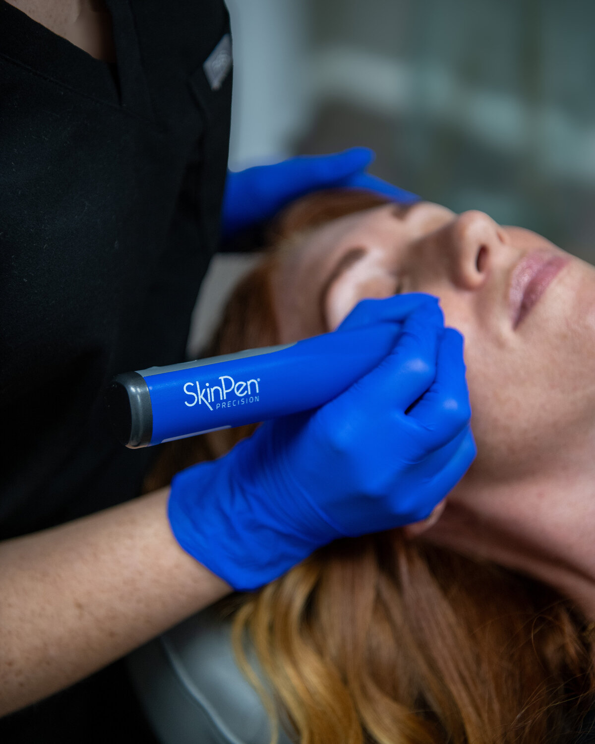 SkinPen Microneedling in Lewis County | Collagen Induction Therapy