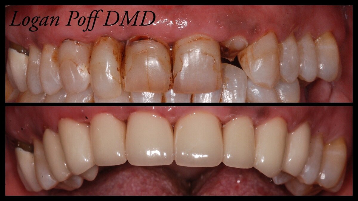 Dental Implants St. Petersburg, FL | Dentures | Tooth Extraction