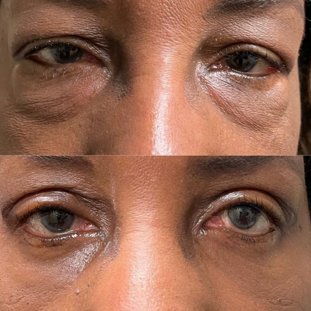 Gallery: Ptosis Repair