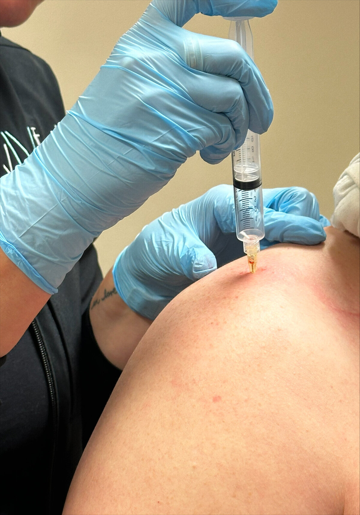 Prolozone Injection Therapy In Clive Ia Vivid Wellness And Aesthetics Lounge