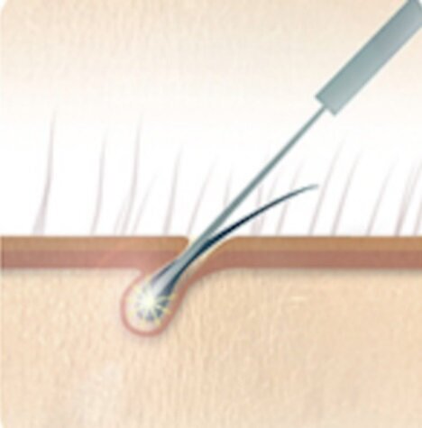 Elektrisch ontharen | Epileren bij Prins Huidtherapie