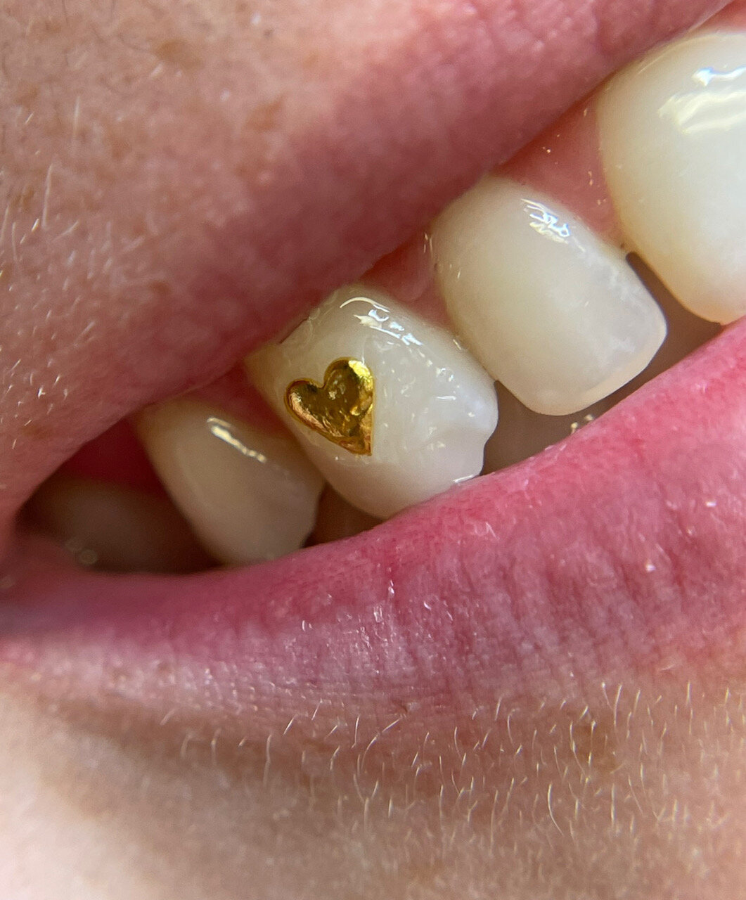 Tooth Gems in Western Massachusetts