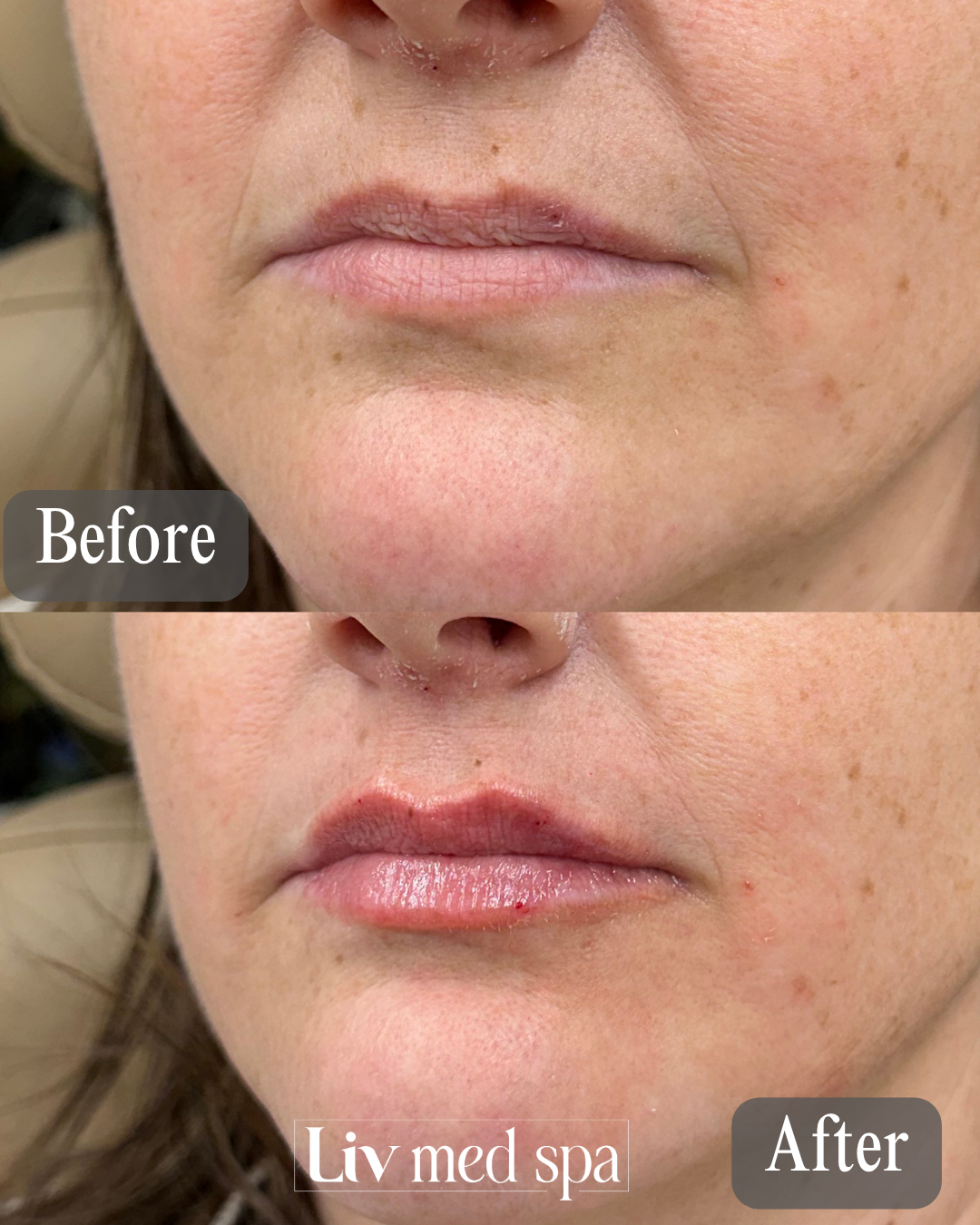 Sioux Falls, SD | Medical Aesthetics & Laser Tattoo Removal