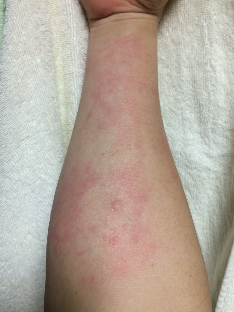 Top Lyme Disease Doctor in Dallas/Ft. Worth